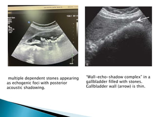 Usg evolution of biliary tree and gallbladder.pptx