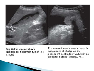 Usg evolution of biliary tree and gallbladder.pptx