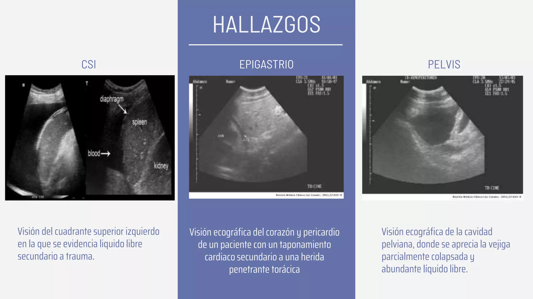 USG FAST en Trauma | PPTX