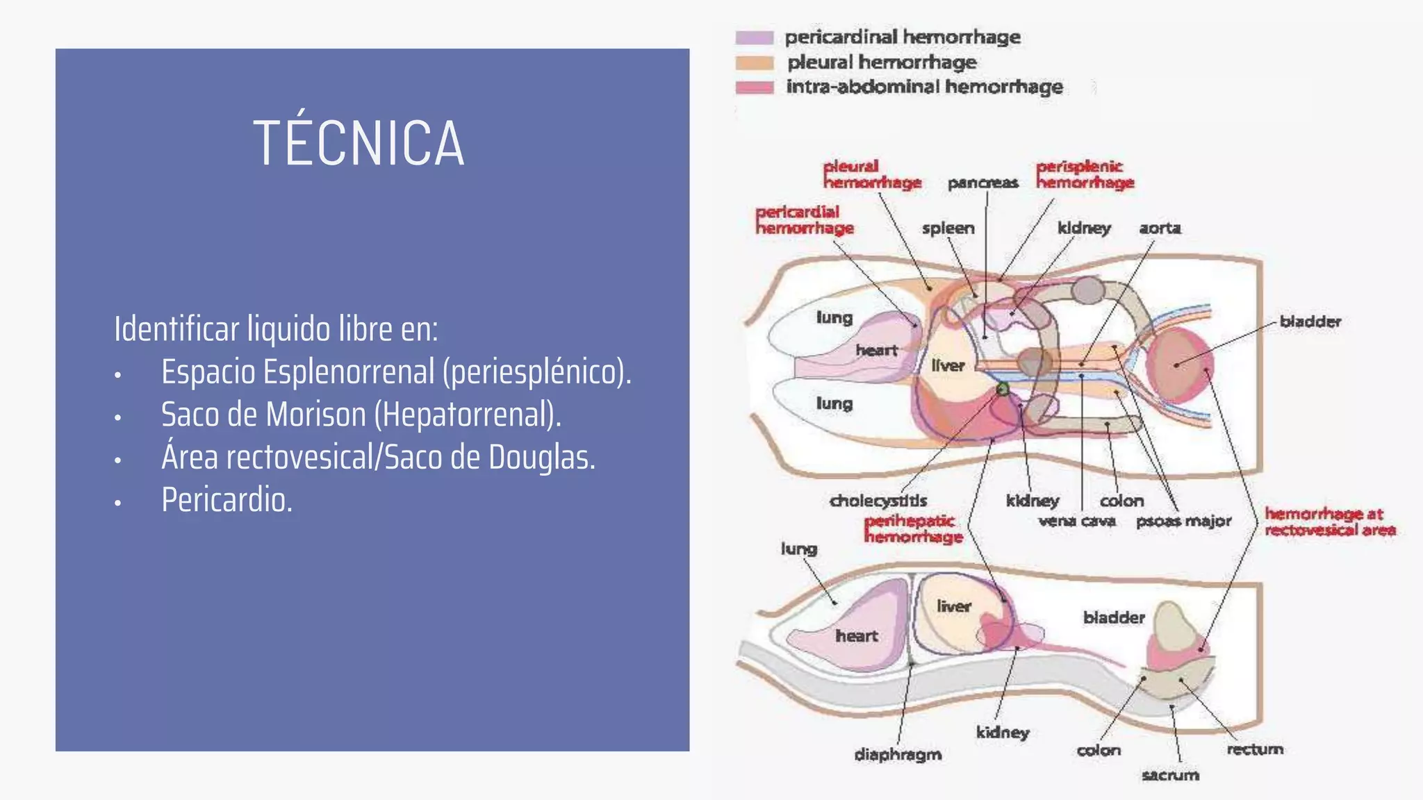 USG FAST en Trauma | PPTX