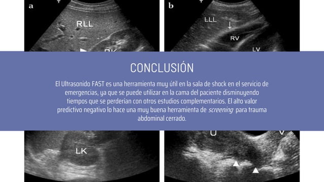 USG FAST en Trauma | PPTX