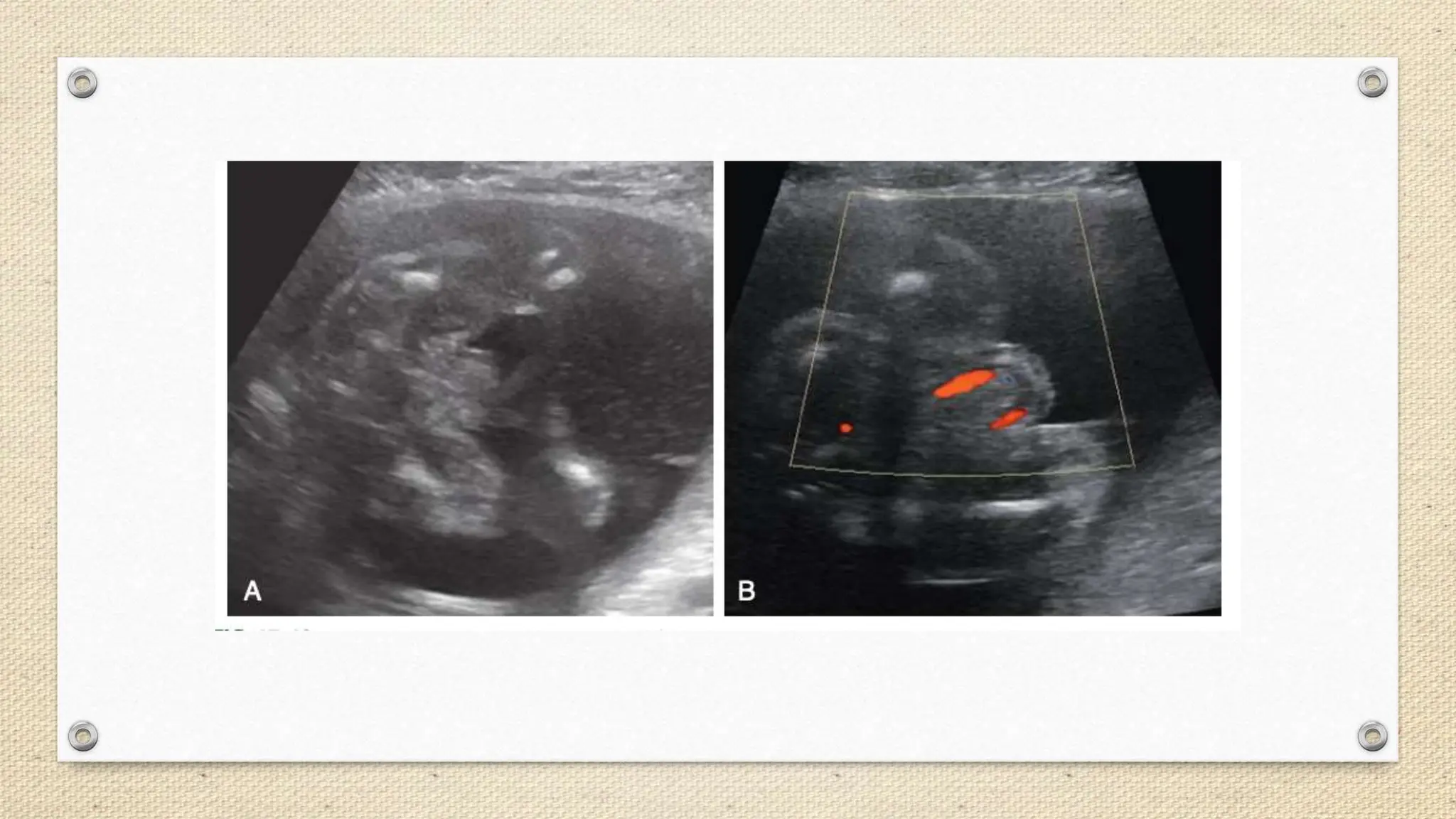 USG Fetal Gut .pptx