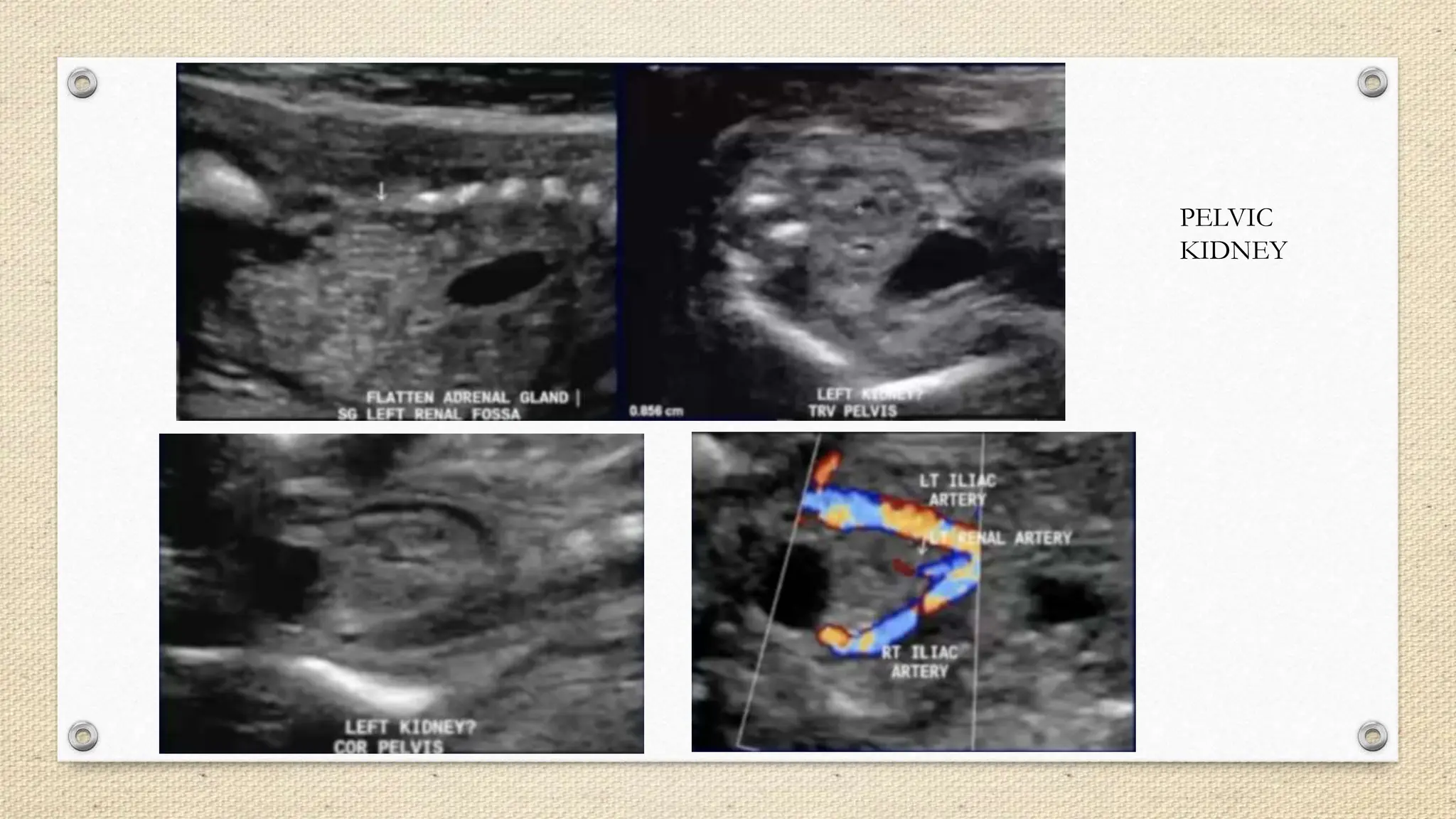 USG Fetal Gut .pptx