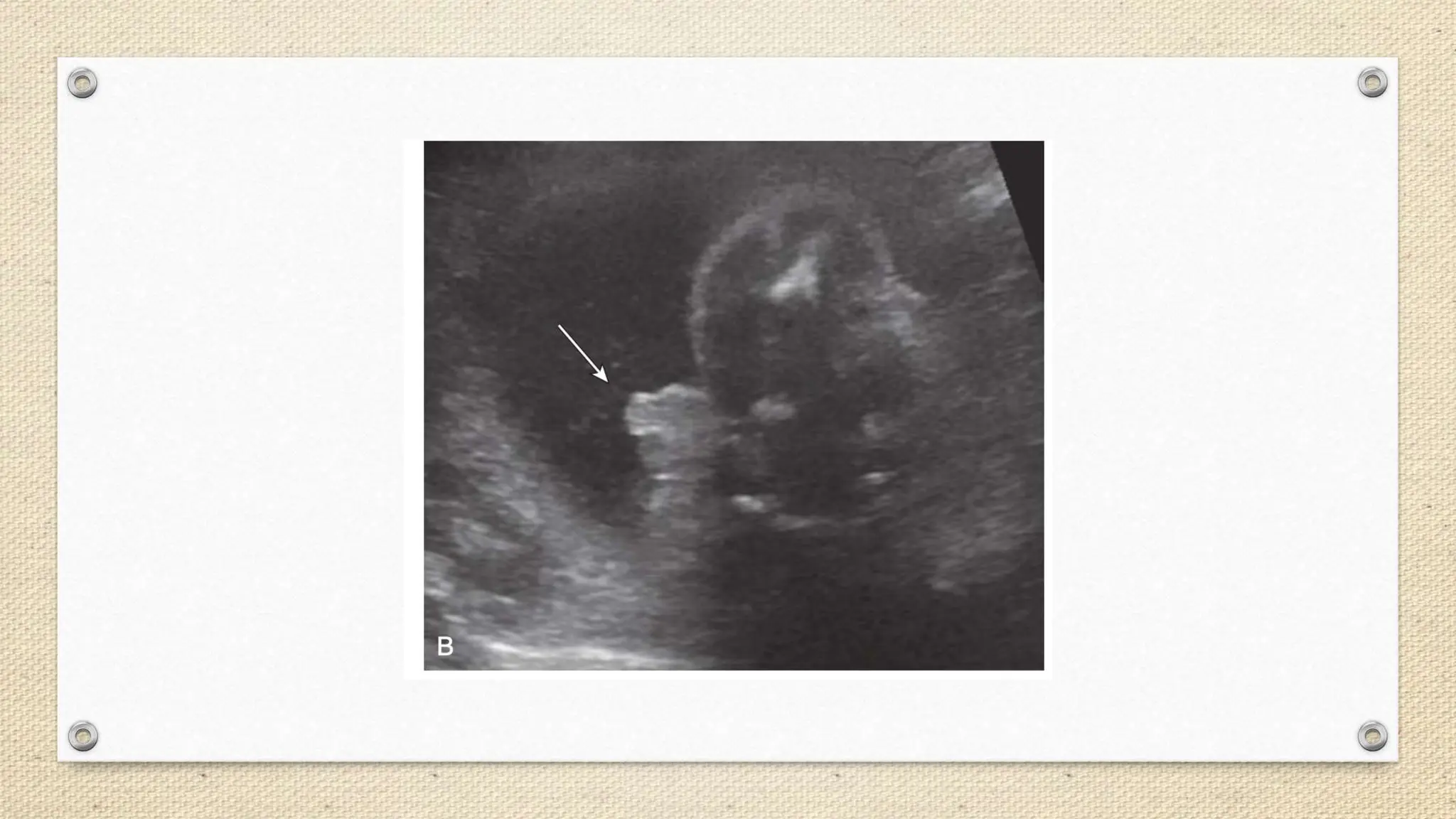 USG Fetal Gut .pptx