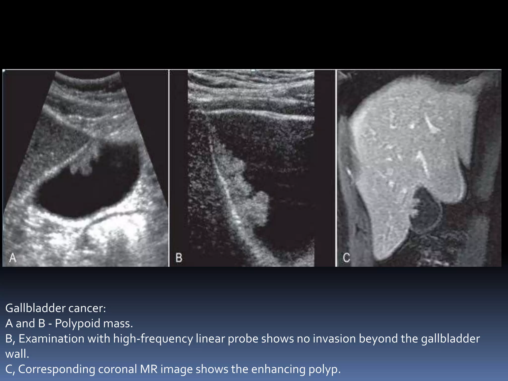 Utrasound Gall-bladder & biliary tract | PPTX