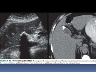 Porcelain Gallbladder Ultrasound