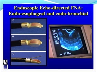 Usg guided FNA biopsy | PPT