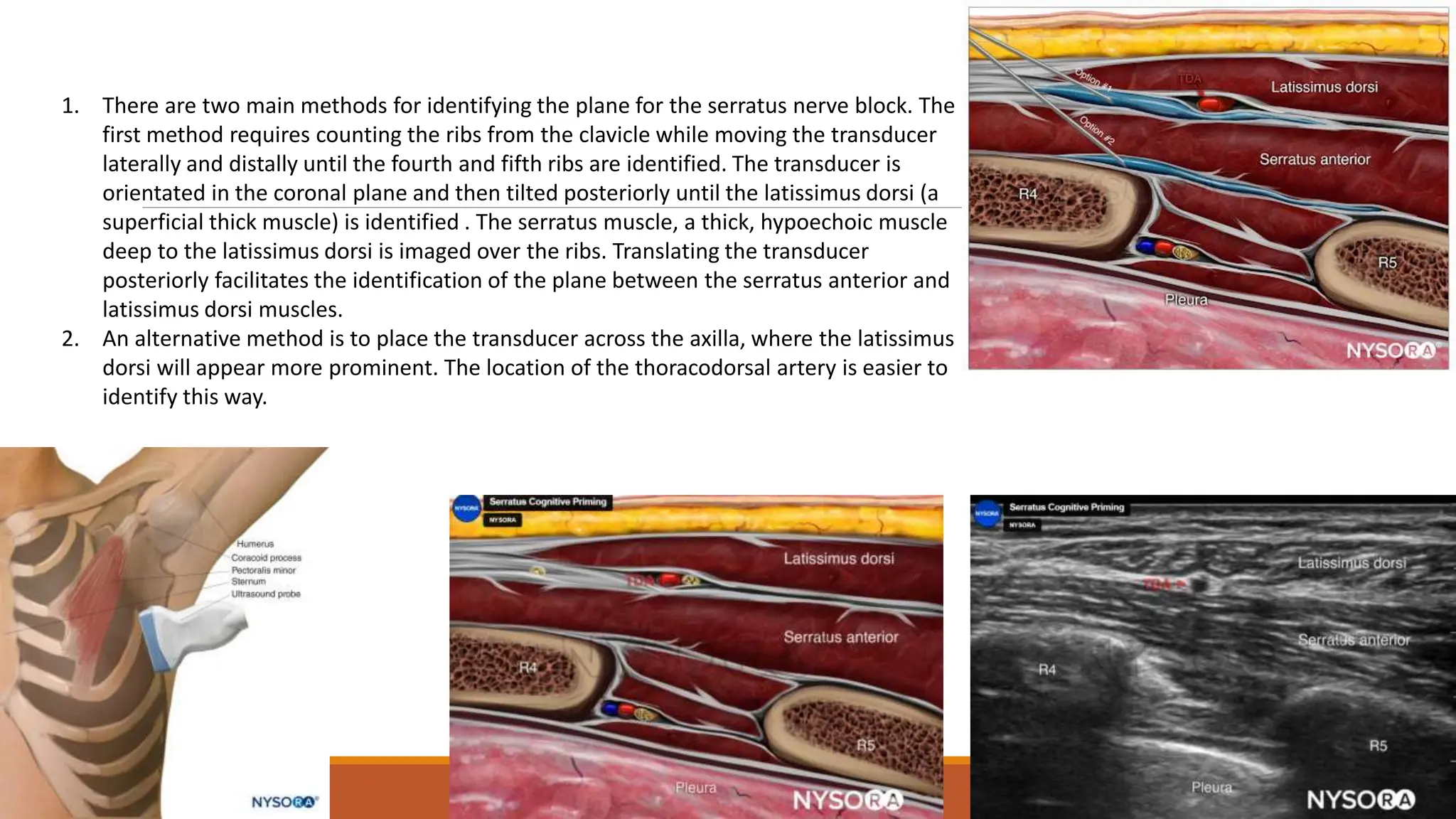 USG GUIDED NERVE BLOCKS PEC 1 PEC 2 BLOCK | PPTX