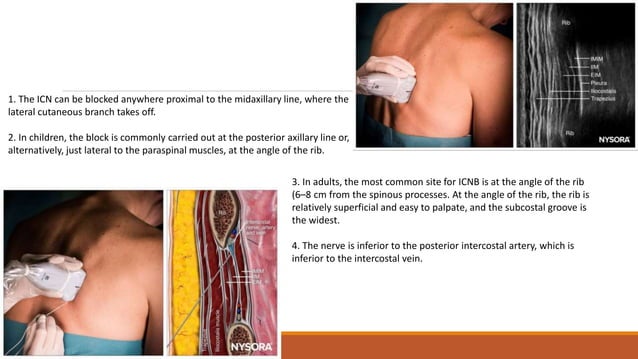 USG GUIDED NERVE BLOCKS PEC 1 PEC 2 BLOCK | PPTX | Death, Injury, or Military Conflict ...