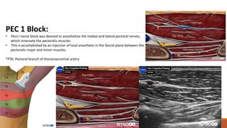 USG GUIDED NERVE BLOCKS PEC 1 PEC 2 BLOCK | PPTX