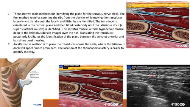 USG GUIDED NERVE BLOCKS PEC 1 PEC 2 BLOCK | PPTX | Death, Injury, or ...