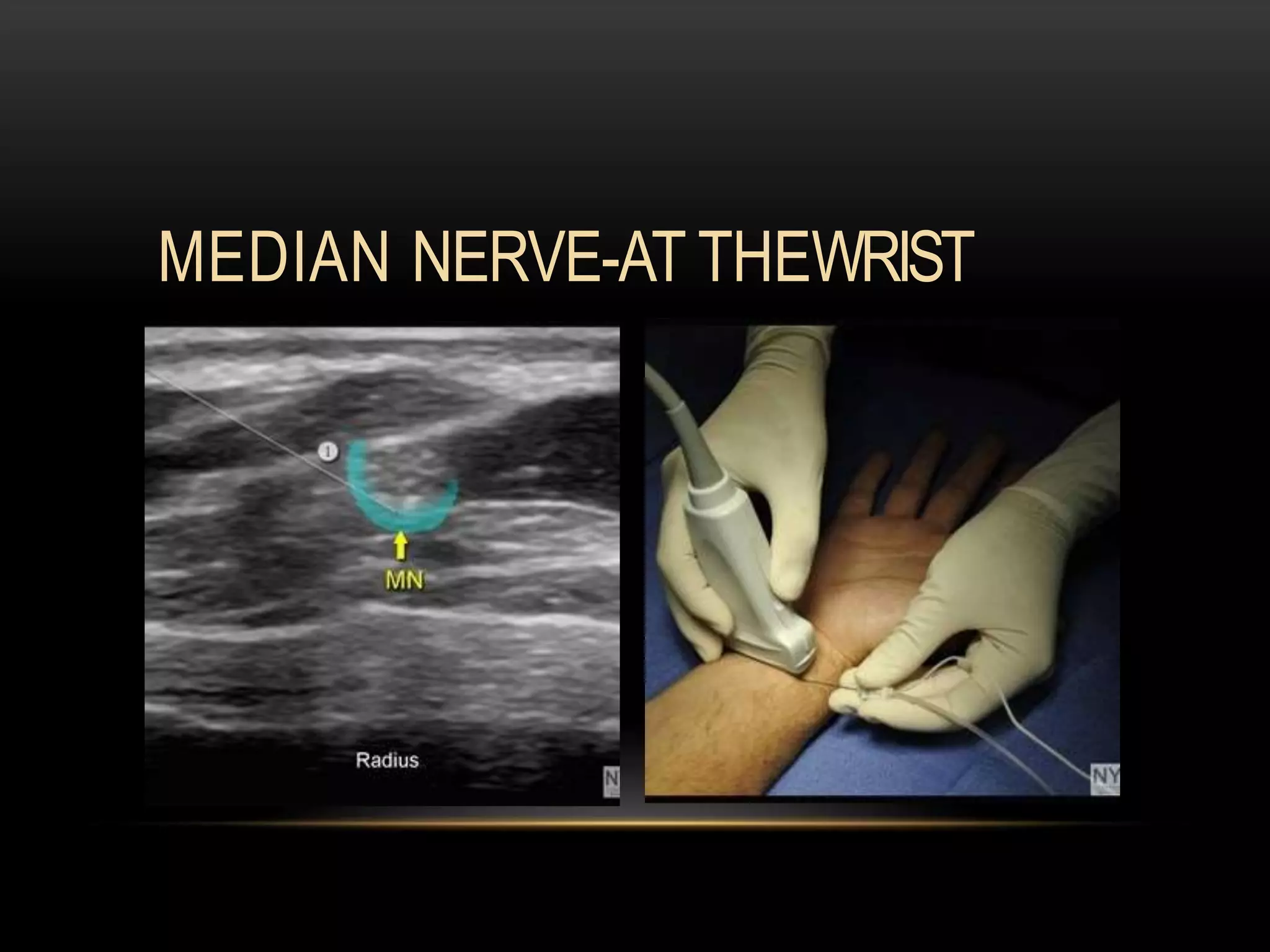 Ultrasound guided nerves block | PPTX