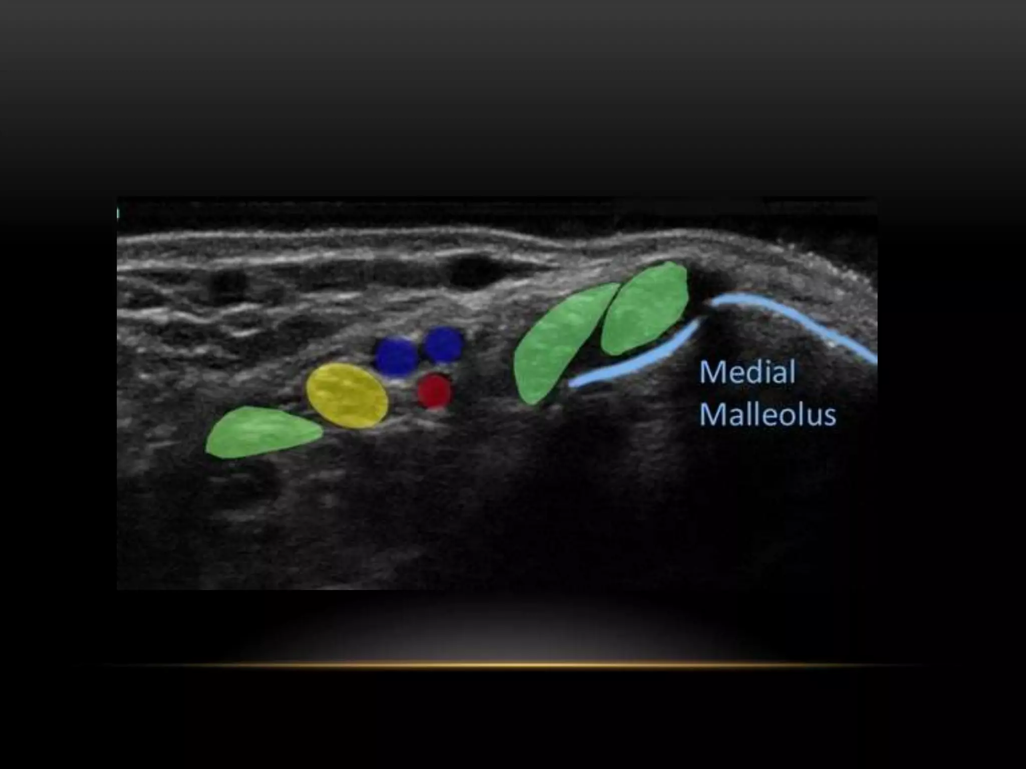 Ultrasound guided nerves block | PPTX