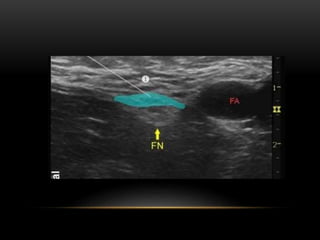 Ultrasound guided nerves block | PPTX