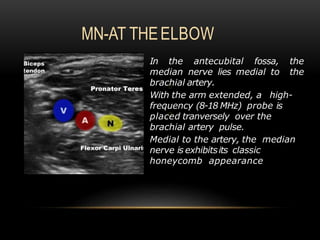 Ultrasound guided nerves block | PPTX
