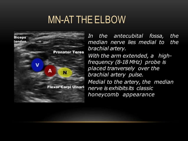 Ultrasound guided nerves block | PPTX | Death, Injury, or Military ...