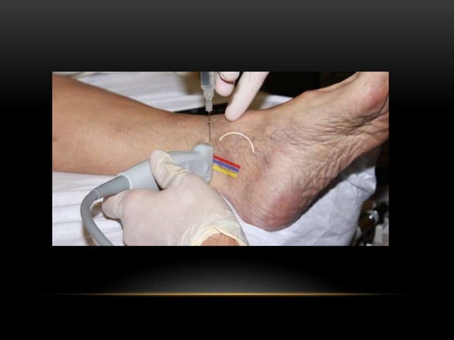 Ultrasound guided nerves block | PPTX | Death, Injury, or Military ...