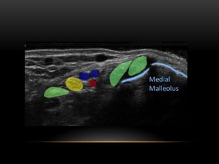 Ultrasound guided nerves block | PPTX