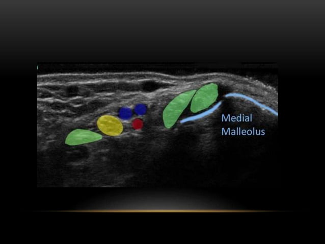 Ultrasound guided nerves block | PPTX | Death, Injury, or Military ...