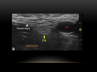 Ultrasound guided nerves block | PPTX