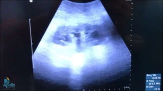 Usg guided pcn insertion [auto saved] | PPTX