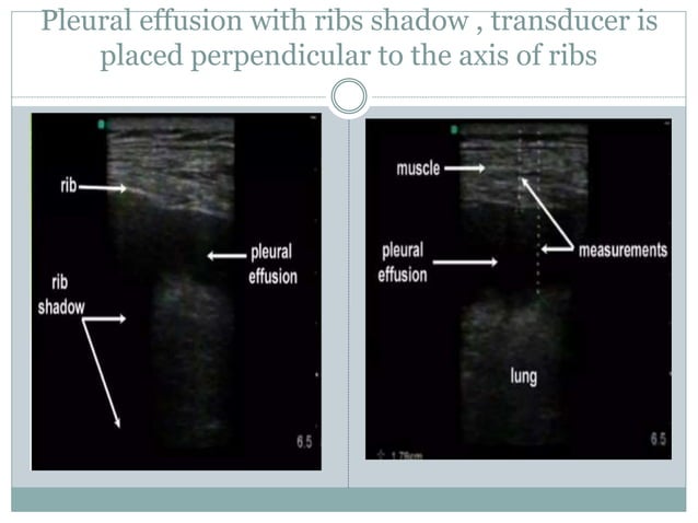 USG Guided Tapping.pptx,Lung Infection Symptom relief (if pleural ...