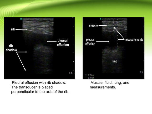 USG Guided Thoracentesis | PPT