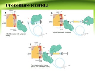 USG Guided Thoracentesis | PPT