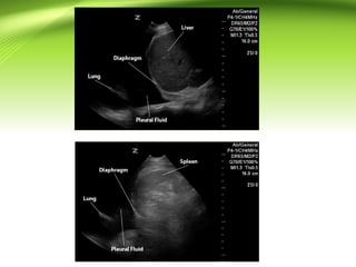 USG Guided Thoracentesis | PPT