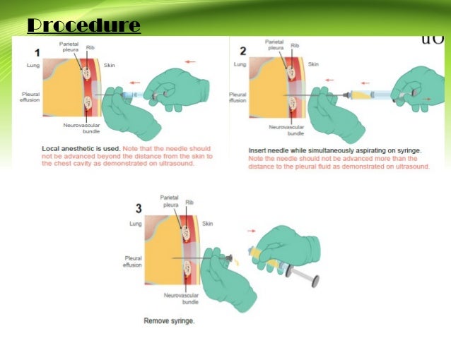 USG Guided Thoracentesis