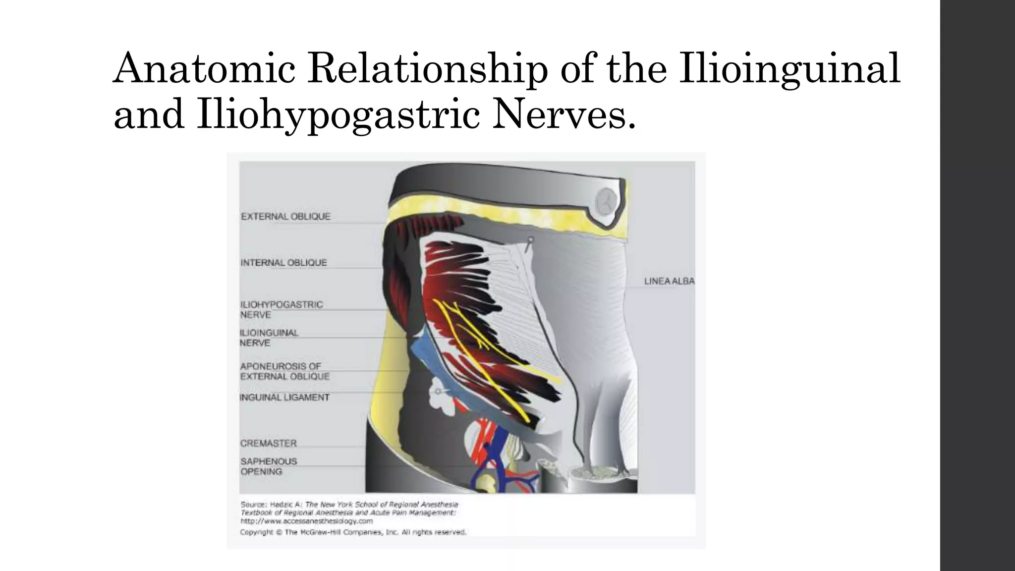 USG Guiding Iliohypogastric Nerve Block.pptx