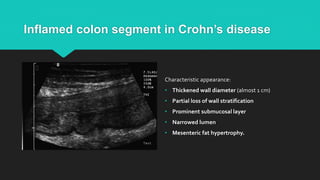 Diagnostics in Inflammatory Bowel Disease (IBD): Ultrasound | PPTX