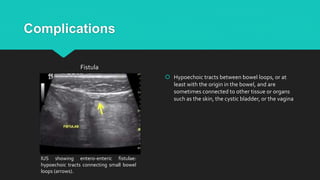 Diagnostics in Inflammatory Bowel Disease (IBD): Ultrasound | PPTX