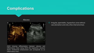 Diagnostics in Inflammatory Bowel Disease (IBD): Ultrasound | PPTX