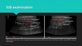 Diagnostics in Inflammatory Bowel Disease (IBD): Ultrasound | PPTX