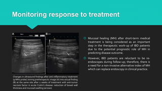 Diagnostics in Inflammatory Bowel Disease (IBD): Ultrasound | PPTX