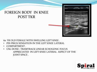 Usg image gallery advanced usg lounge | PPT