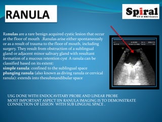 Usg image gallery advanced usg lounge | PPT