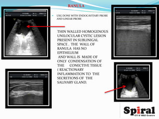 Usg image gallery advanced usg lounge | PPT