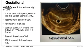 USG in early pregnancy seminar ppt.pptx
