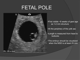 Yolk Sac Fetal Pole