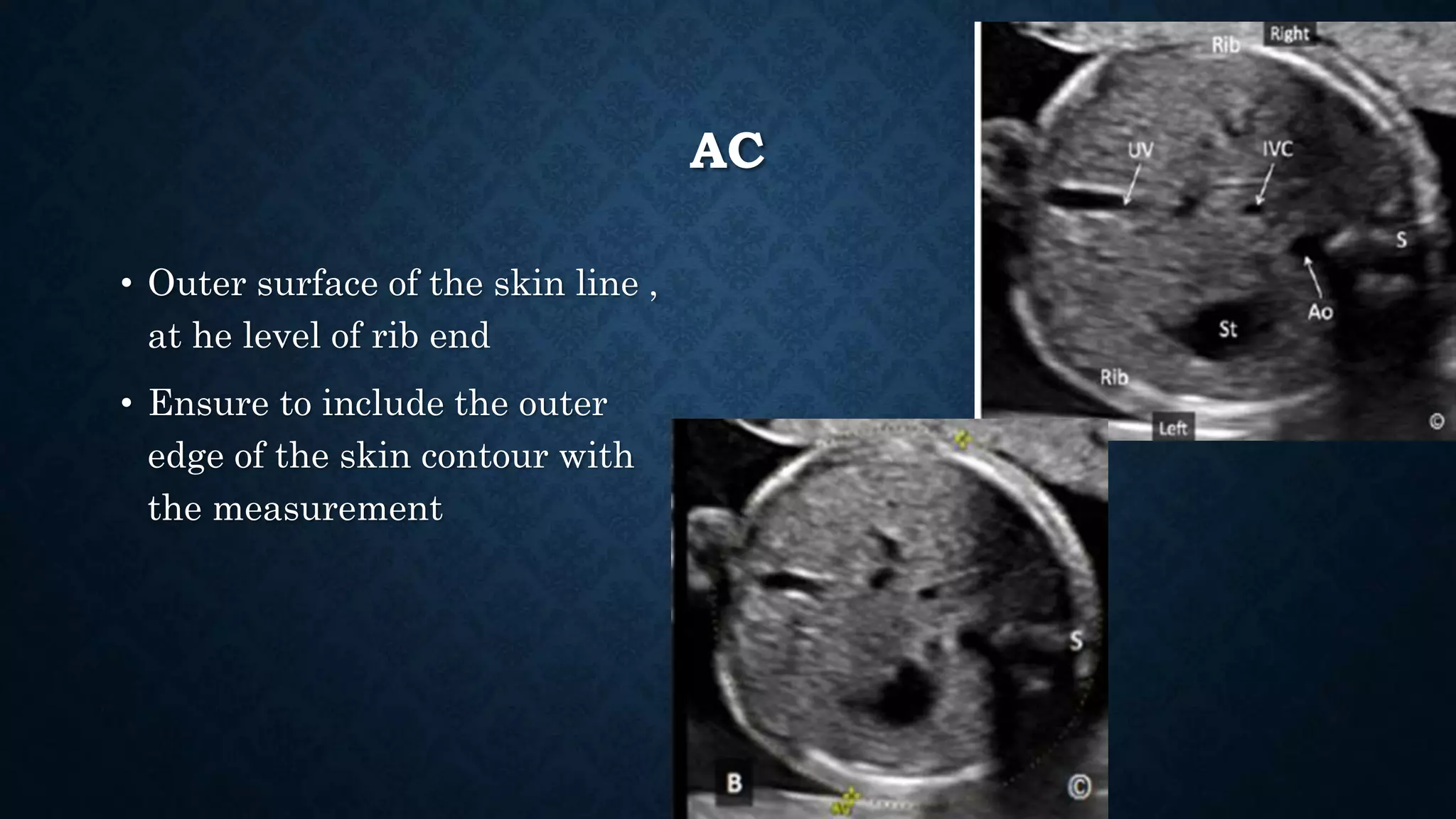 Usg in second trimester | PPTX
