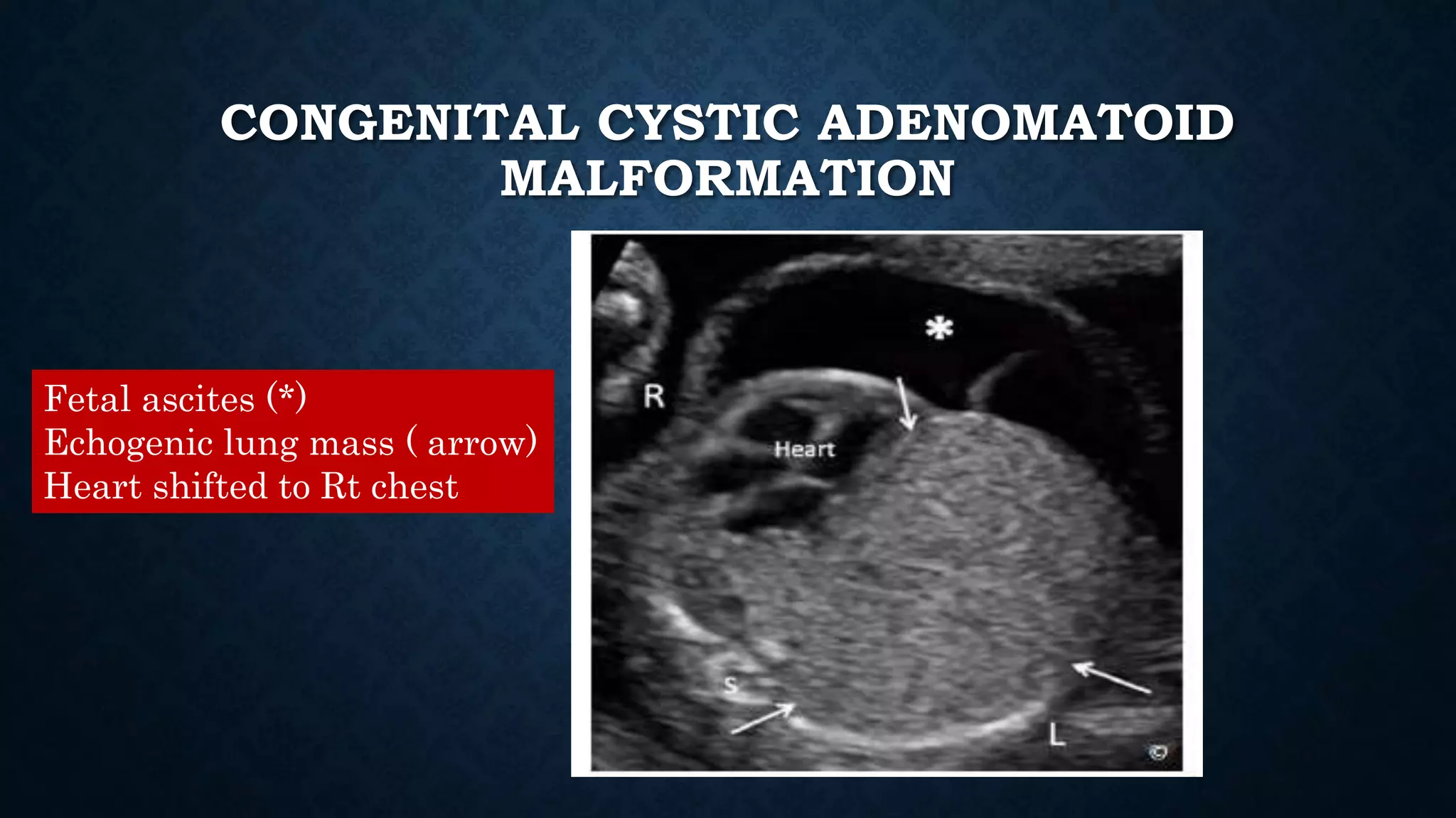 Usg in second trimester | PPTX