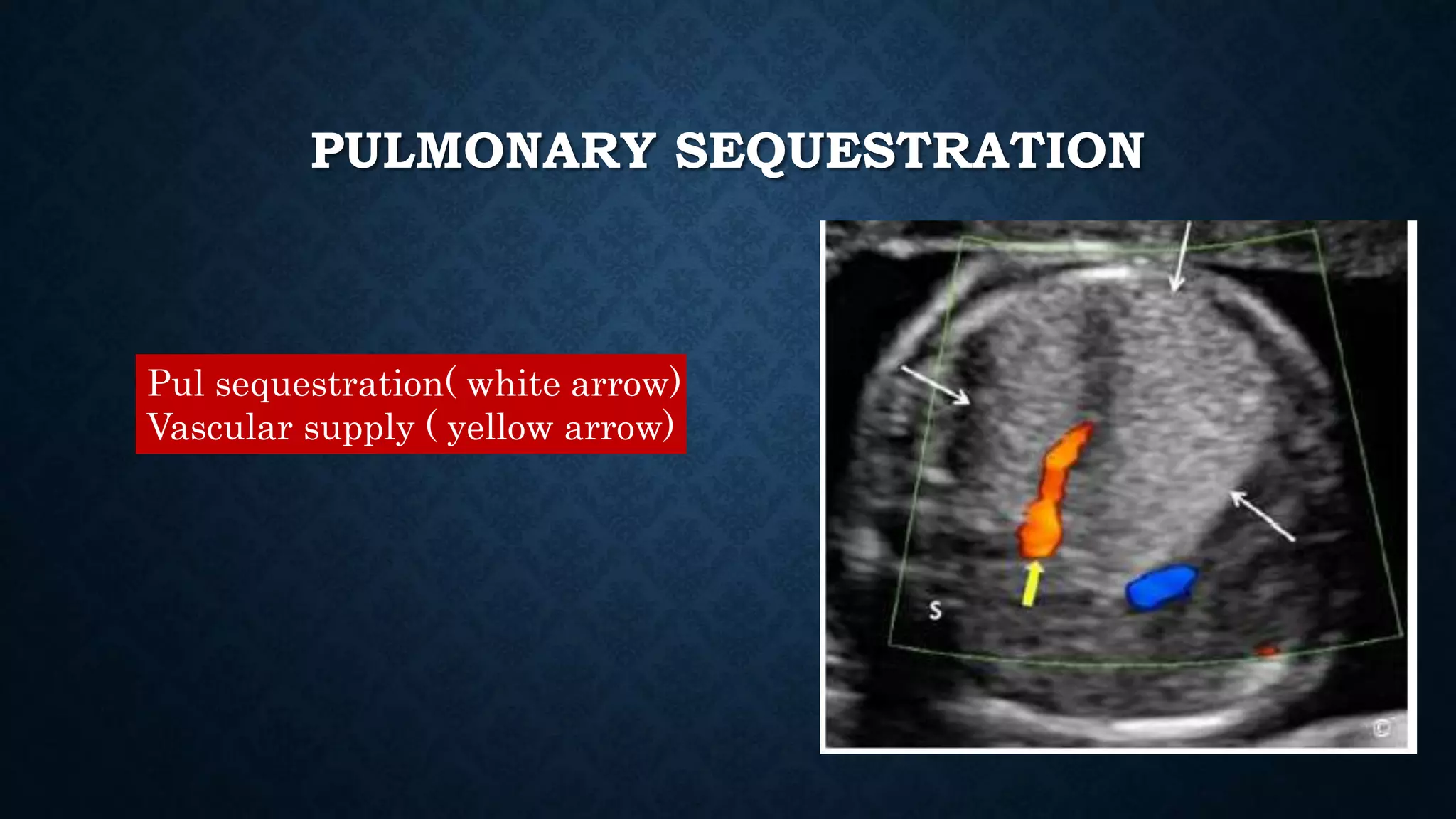 Usg in second trimester | PPTX