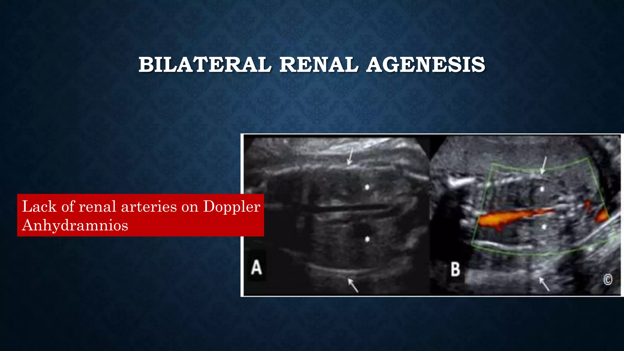 Usg in second trimester | PPTX