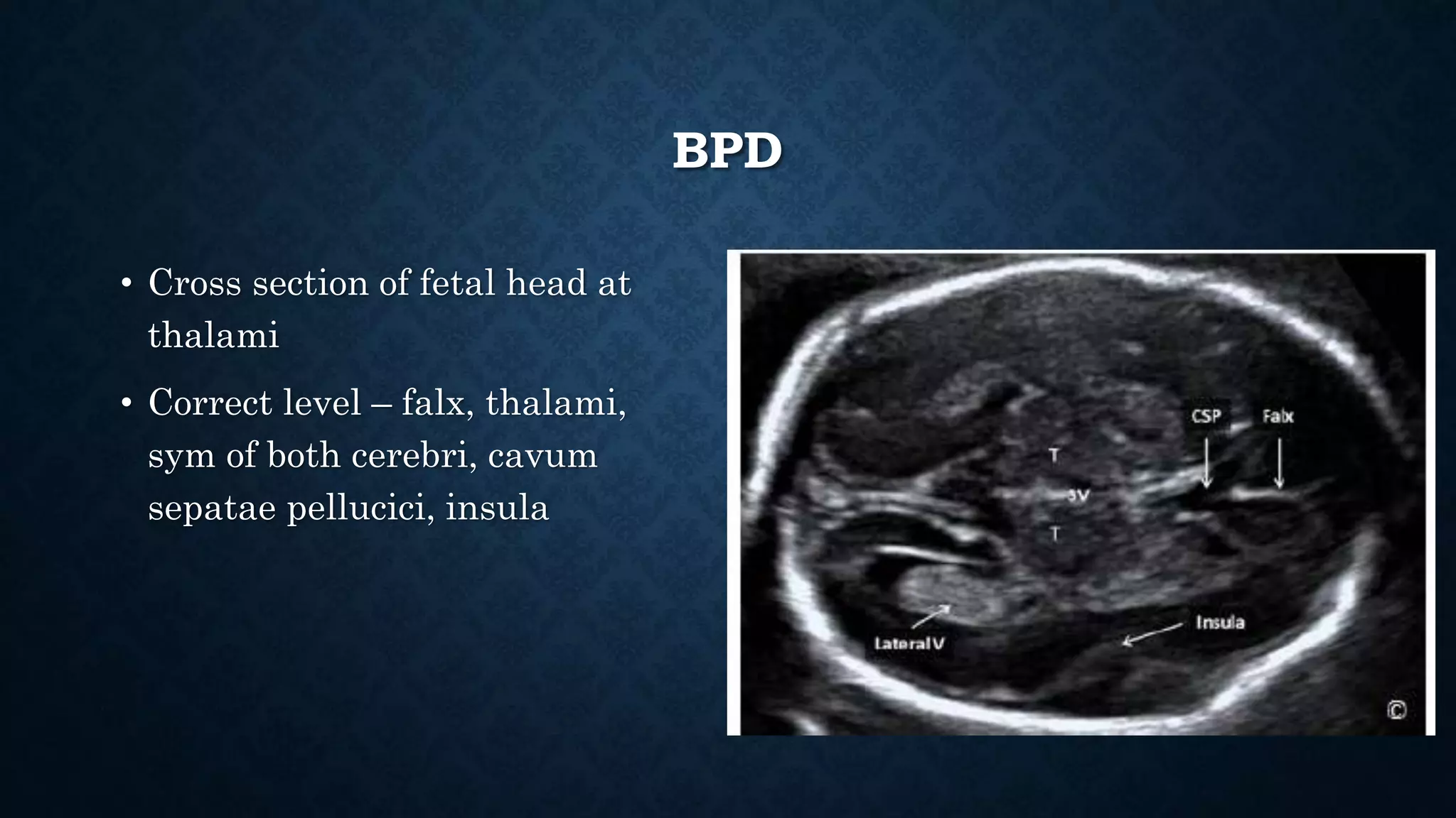 Usg in second trimester | PPTX