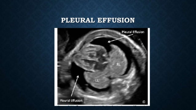 Usg in second trimester | PPTX