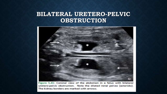 Usg in second trimester | PPTX