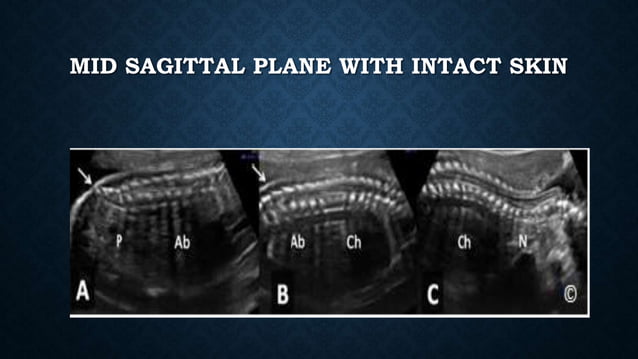 Usg in second trimester | PPTX