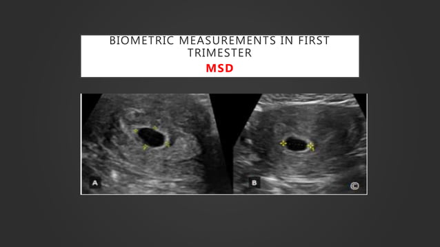 Usg in first trimester | PPTX